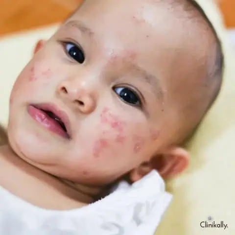 Understanding Baby Acne and How To Treat It - Baby Chick