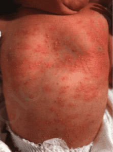 Baby Heat Rash: Symptoms, Causes, and Treatments - Baby Chick