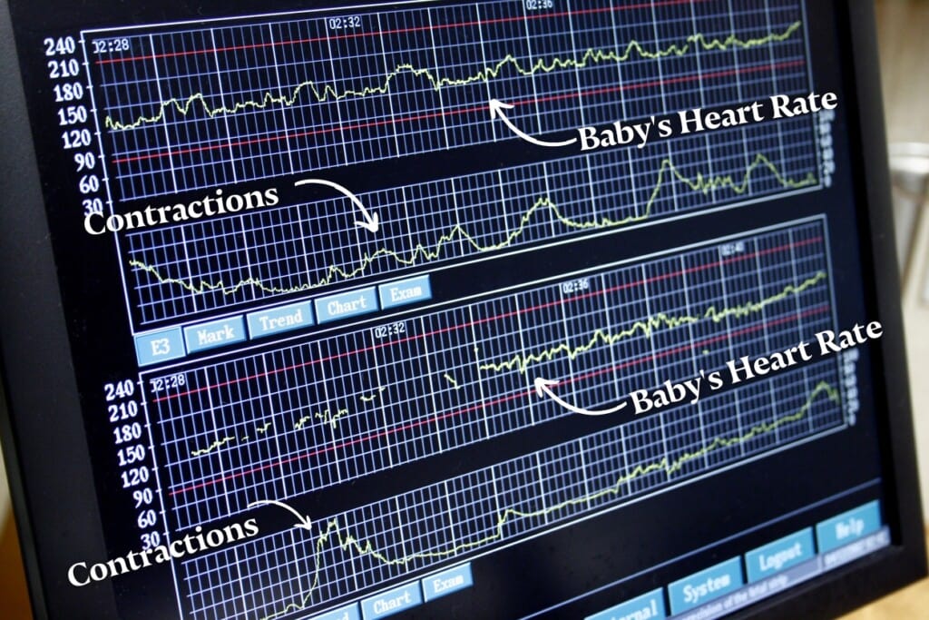 What Is Early Fetal Heart Rate Deceleration? - Baby Chick