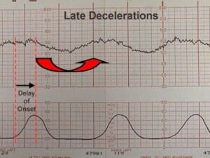 What Is Early Fetal Heart Rate Deceleration? - Baby Chick