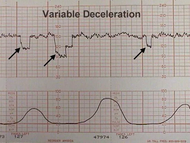 What Is Early Fetal Heart Rate Deceleration?
