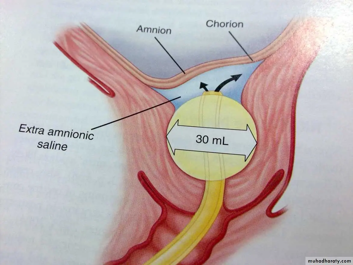 Foley Bulb Induction for Labor: What To Expect - Baby Chick