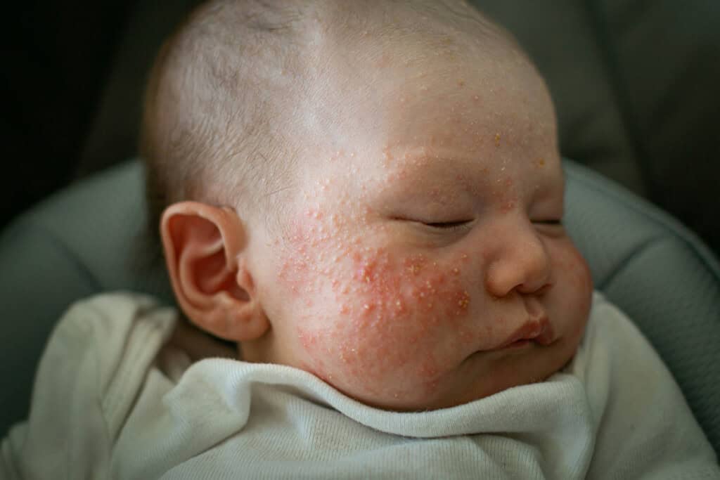 Understanding Baby Acne and How To Treat It - Baby Chick